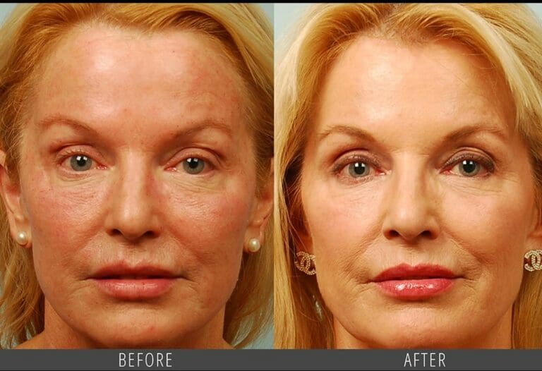 Vivace Ultra Microneedling — Bella MediSpa & Salon